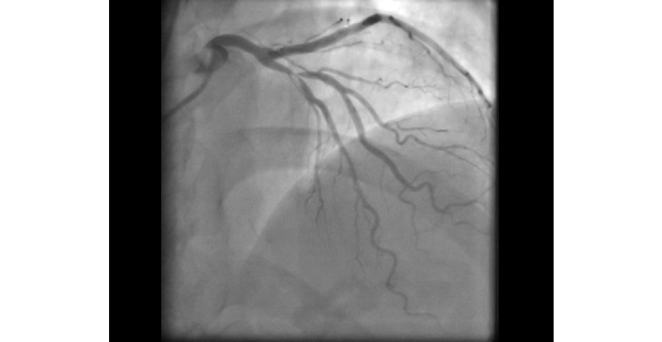 Coronary Angiography | Dr David Brull
