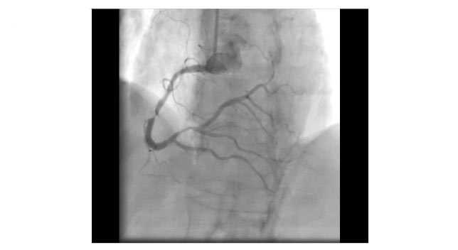 Percutaneous Coronary Intervention | Dr David Brull