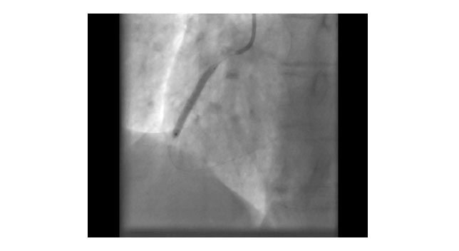Percutaneous Coronary Intervention | Dr David Brull